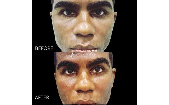 Cheek Fillers & Tear Troughs · Rancho, Inland Empire by Gemini Plastic ...