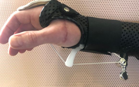 Occupational Therapy, Physiotherapy, Certified Hand Therapy ,wound care ...