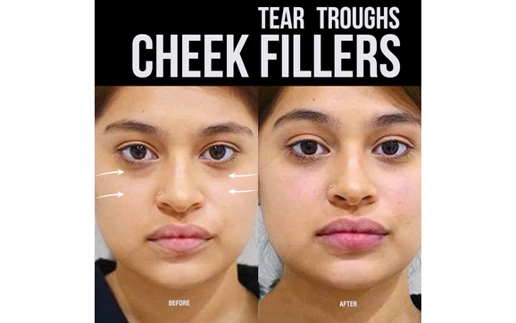 Tear Troughs & Cheek Fillers in Rancho Cucamonga, Inland Empire by ...