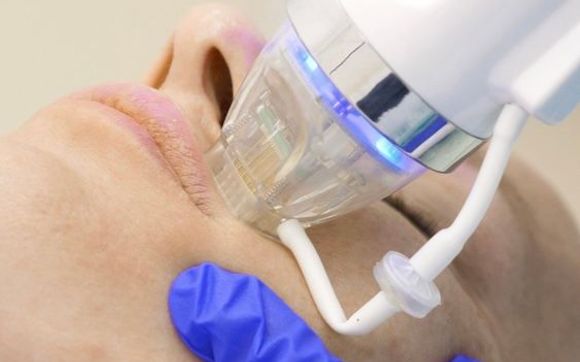 CANDELA EXCEED MICRONEEDLING by ÉCLAT Skin Confidence Spa & Academy in ...