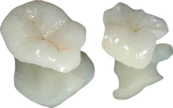 TCS Nesbit/Flipper by Rite Smile Dental Laboratory Network | PCDL ...