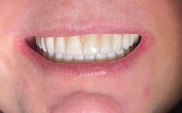 Dental implants for new beautiful and functioning smile! by Advanced ...