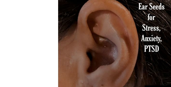 Ear Seeds By Rtb Spa In Houston Tx Alignable