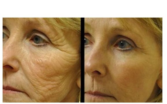 INTRODUCING TRILIFT BY LUMENIS by Integrative Health Recreation & Musu ...