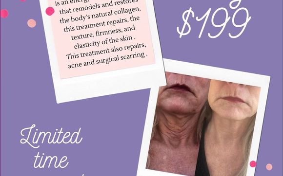 Morpheus eight RF micro needling. EM technology body sculpting.. micro ...