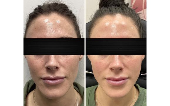 Lipotropic injections - the skinny shot by Confident Med Spa in Epping ...