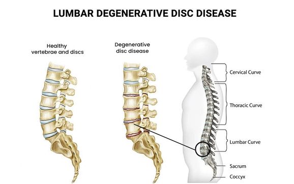 Lumbar Degenerative Disc Disease Treatment in New Jersey by NU-Spine ...