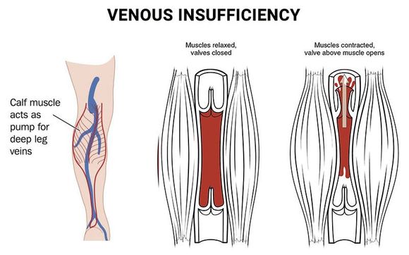 Venous Insufficiency Treatment in NYC by Vein Care Center in New York, NY - Alignable