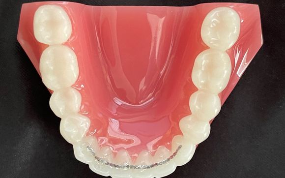 Permanent Orthodontic Retainers by Stellar Smiles Ortho in Grapevine ...