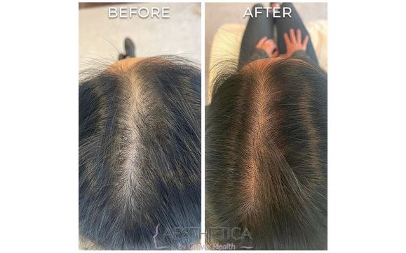 Scalp Micro-needling by Grover Health & Wellness and Aesthetica in ...