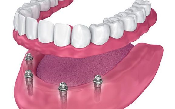 Prostho Dental Implants & Aesthetic Dentistry - Alignable