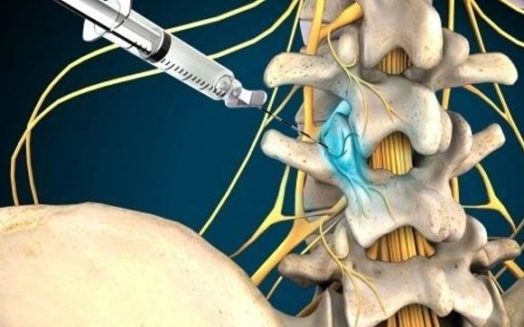 Medial Branch Nerve Blocks by Pain Physicians NY in New York, NY ...