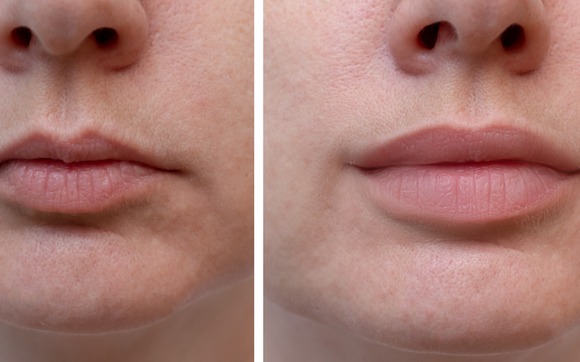 lip filler by Sama Spa inc Medical Spa best botox filler laser hair ...