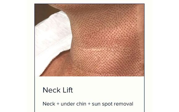 Neck Lift By Skinfix Babe In Scottsdale Az Alignable
