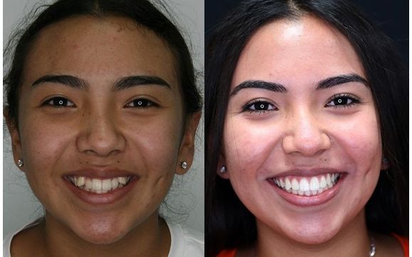Smile Arc with Pitts 21 Braces by Doctor Smiles Orthodontics in Tucson ...