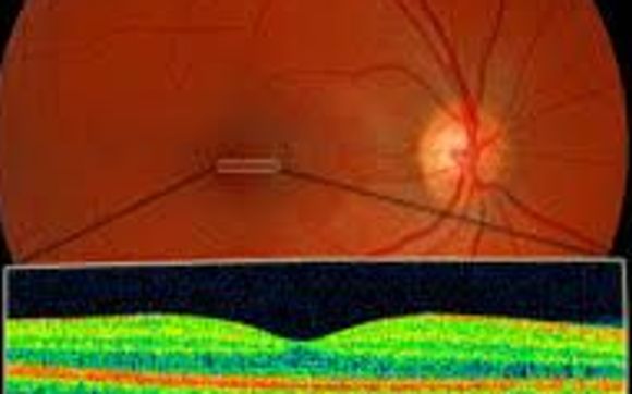 Retinal Scan and photos for baseline evaluation of the back of your eye ...