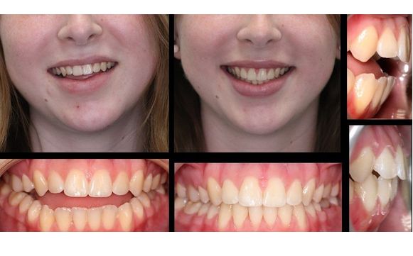 Smile Arc with Pitts 21 Braces by Doctor Smiles Orthodontics in Tucson ...