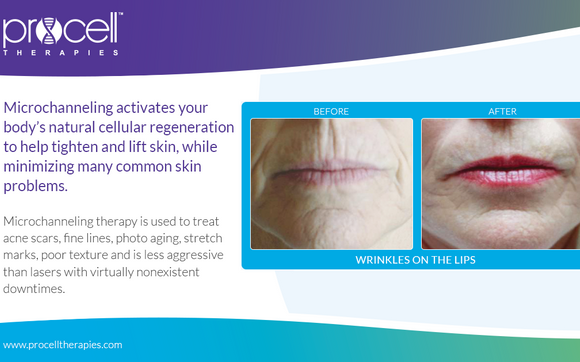 ProCell™ Microchanneling with PRP aka Vampire FACIAL by Med Spa At ...