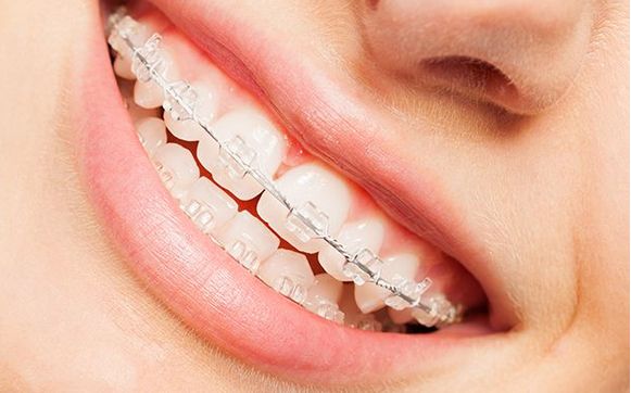 Lightforce Clear Custom 3D Printed Braces by Heritage Orthodontics in ...