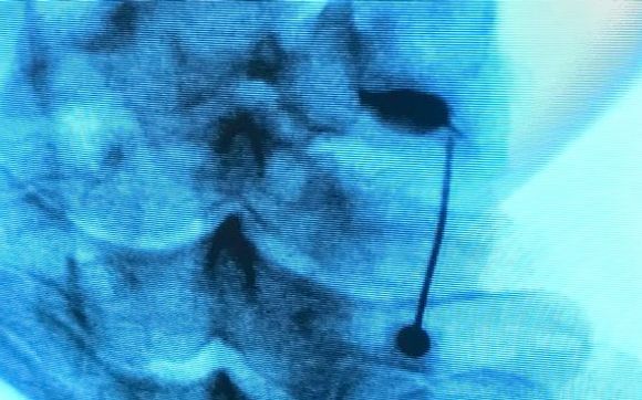 Precision image guided regenerative injections for neck and shoulder ...