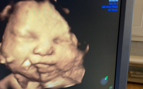 Ultrasounds 2D,3D and 4D/HD Live by The Peek A Baby 3/4D Ultrasound ...