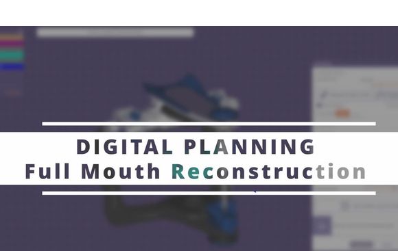 Digital Planning: Full Mouth Reconstruction by PRO-ART DENTAL ...