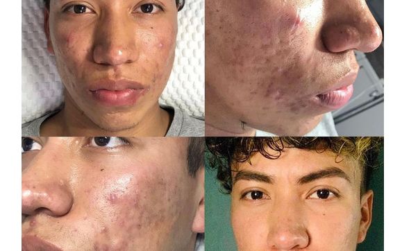 ACNE, ACNE SCARING, ANTI-AGING, PIGMENTATION by MT Skin Clinic & Beauty ...