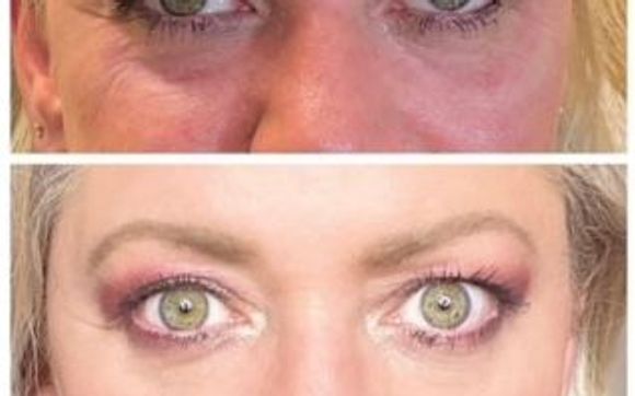 PRP (Platelet Rich Plasma or Exosomes Treatment by The Face Place tm ...