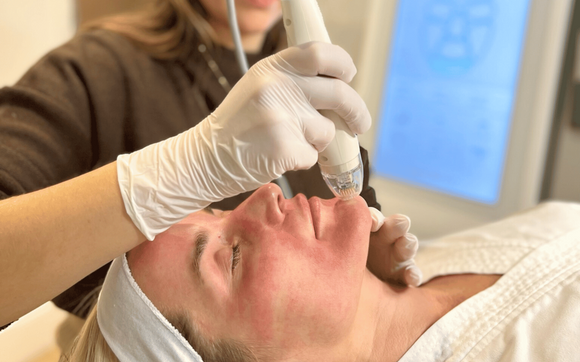 Vivace Ultra Radiofrequency Microneedling at SLK Chattanooga by SLK ...