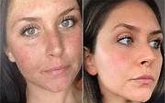 Laser Toning for Treating Melasma by Executive Skin and Laser in The ...