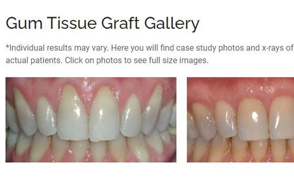 GUM TISSUE GALLERY by NYC Periodontics and Implant Dentistry: Scott O ...
